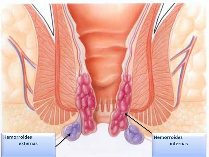hemorroides internas sintomas